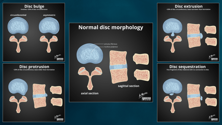 A Majority of Disc Herniations Resorb – Lamb Chiropractic CNY